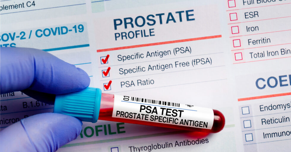 What Is a PSA Test? Understanding Prostate Screening